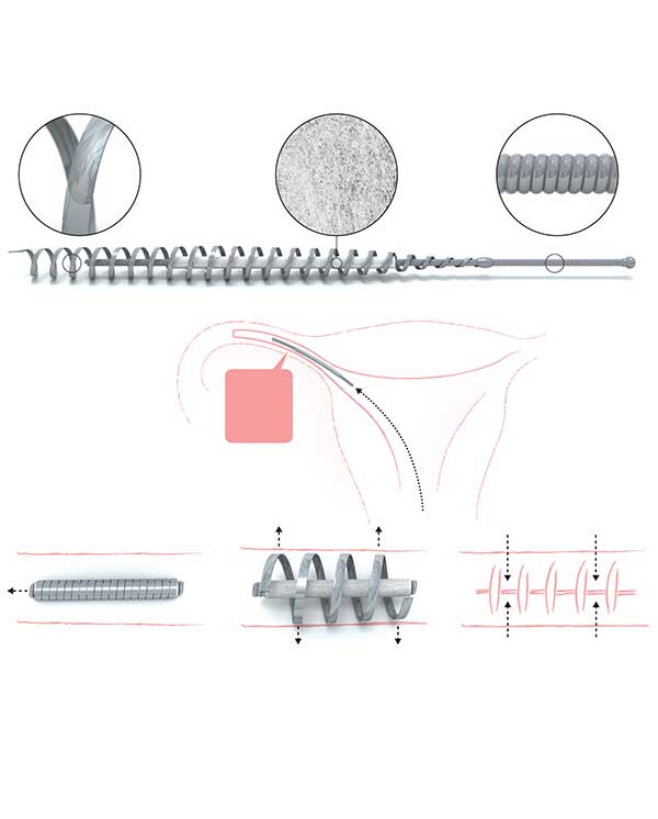 Essure Birth Control Dangers | Chandler McNulty LLP